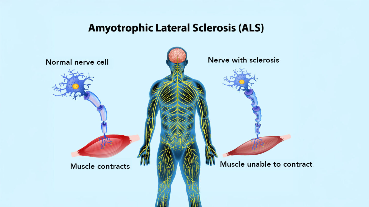 ALS and Aid in Dying | Academy of Aid-in-Dying Medicine